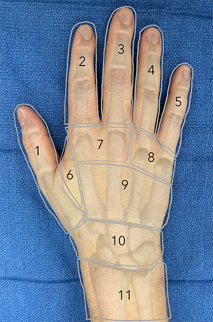 Dorsal Hand/Wrist/Thumb/Fingers | Anatomic Structures at Risk